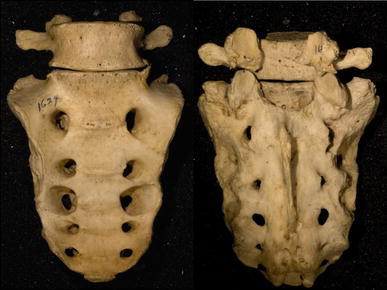 Bilateral Pars Defects at the L4 Vertebra Result in Increased ...