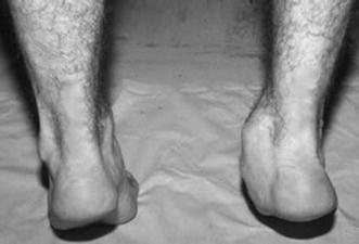 Classifications in Brief: Johnson and Strom Classification of Adult ...