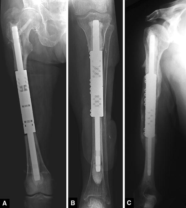 Outcomes of a Modular Intercalary Endoprosthesis as Treatment for ...