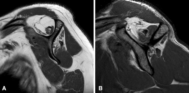 Classifications in Brief: Goutallier Classification of Fatty ...