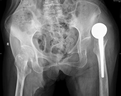 What Are the Risk Factors for Dislocation of Hip Bipolar ...