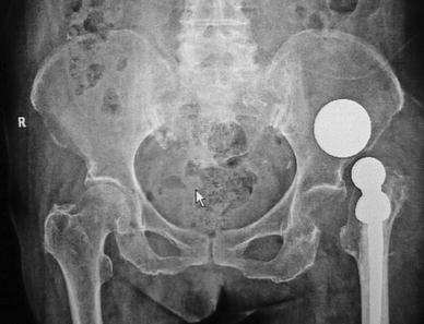 What Are the Risk Factors for Dislocation of Hip Bipolar ...