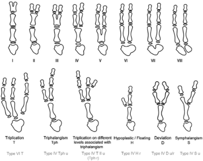 Classifications in Brief: The Wassel Classification for Radial ...