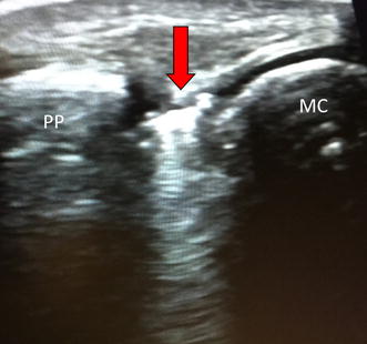 “Knuckle Cracking”: Can Blinded Observers Detect Changes with Physical ...