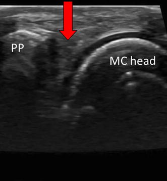 “Knuckle Cracking”: Can Blinded Observers Detect Changes with Physical ...