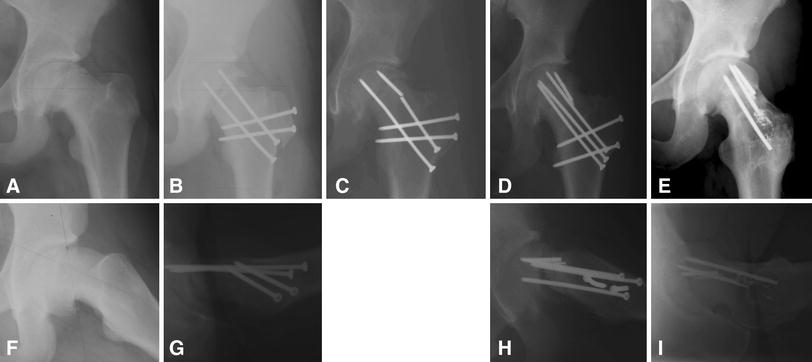 High Survivorship and Little Osteoarthritis at 10-year Followup in SCFE ...