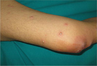 Autoinflammatory Skin Disorders in Inflammatory Bowel Diseases ...