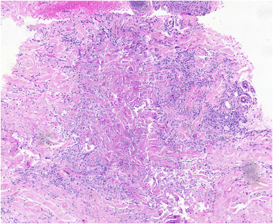 Cutaneous Granulomatosis: a Comprehensive Review | SpringerLink