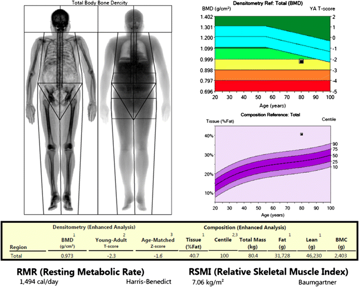 Evaluation of Sarcopenia by DXA | SpringerLink