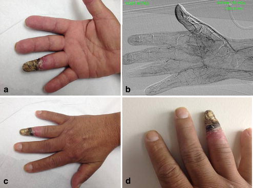 Gangrene from finger pricking | SpringerLink