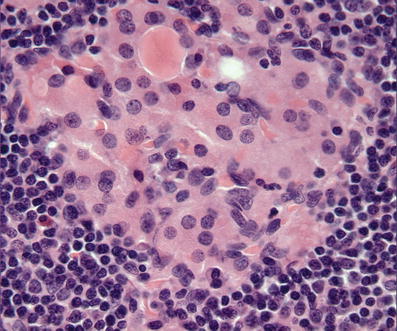 Oncocytes, Oxyphils, Hürthle, and Askanazy Cells: Morphological and ...