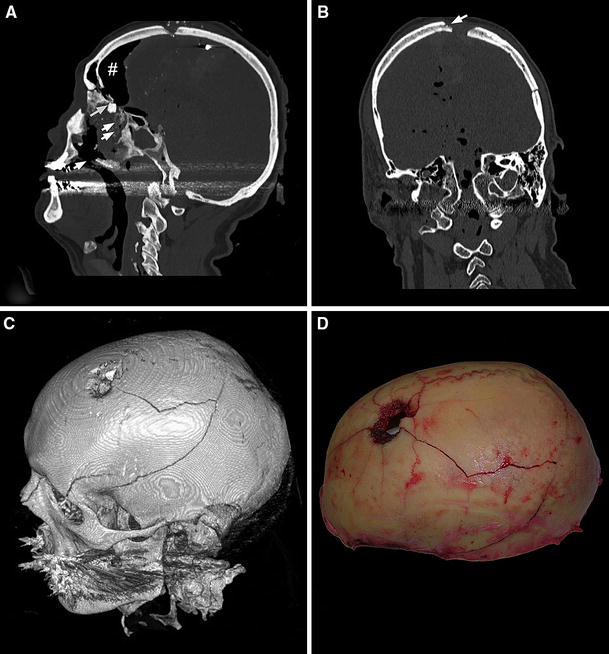 Intersecting fractures of the skull and gunshot wounds. Case report and ...