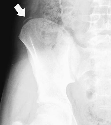 The Risser sign for forensic age estimation in living individuals: a ...