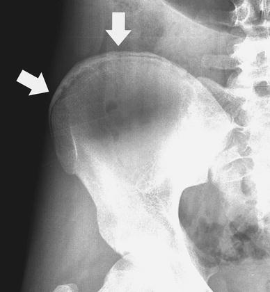 The Risser sign for forensic age estimation in living individuals: a ...