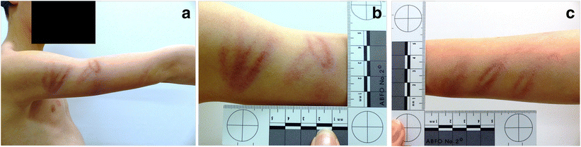 Examples of tramline bruises in clinical forensic medicine | SpringerLink