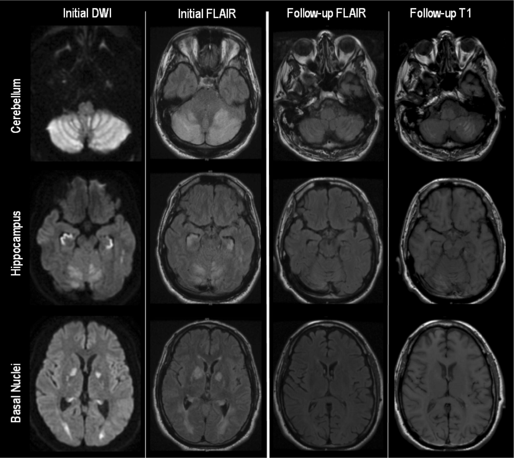 Cerebellar Hippocampal and Basal Nuclei Transient Edema with Restricted ...