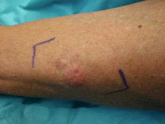 Primary leiomyosarcoma of the skin: a comprehensive review on diagnosis ...