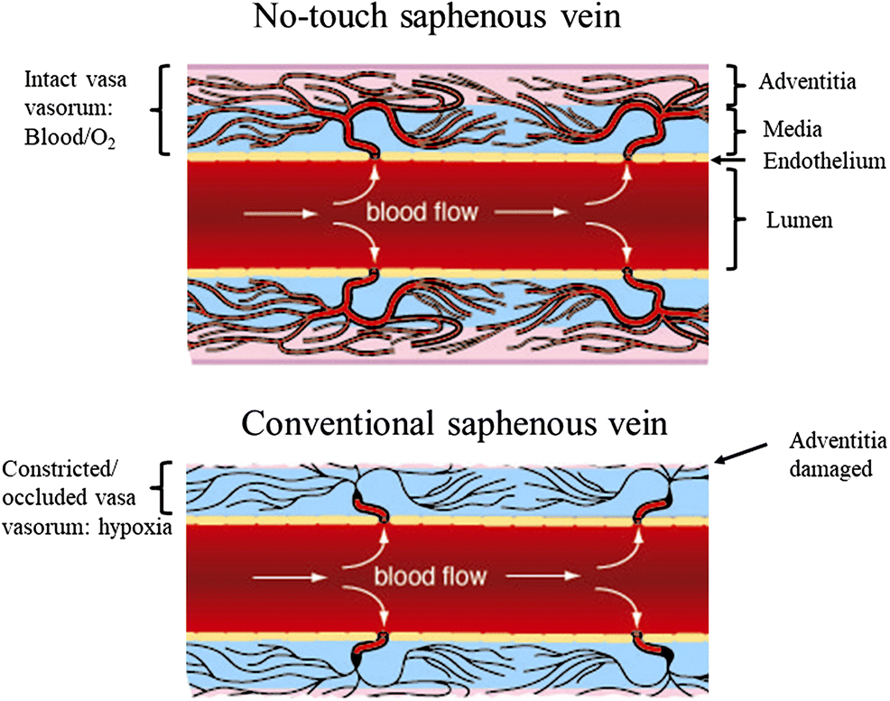 Vasa vasorum inside out/outside in communication: a potential role in ...