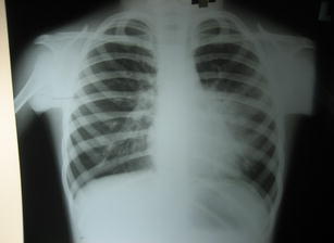 Stevens Johnson Syndrome in Association with Mycoplasma Pneumonia ...
