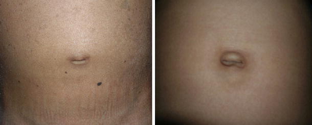 Umbilical Signs of Peritoneal Tuberculosis in Children | SpringerLink