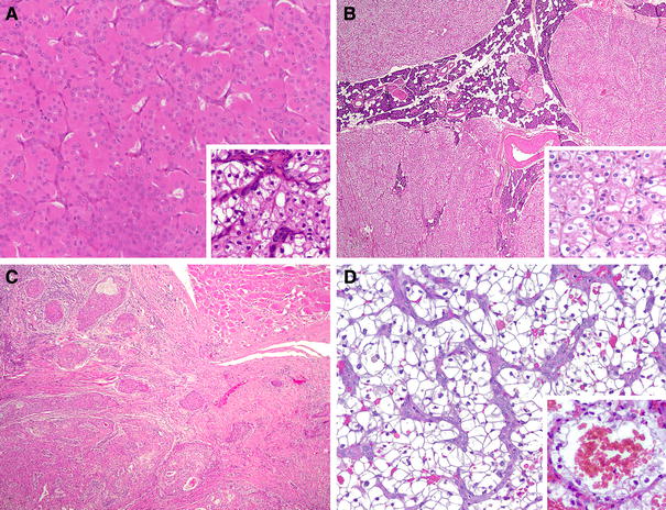 p63 Immunohistochemistry Differentiates Salivary Gland Oncocytoma and ...