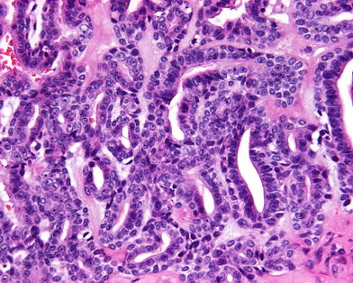 Ceruminous Gland Carcinomas: A Clinicopathologic and Immunophenotypic ...