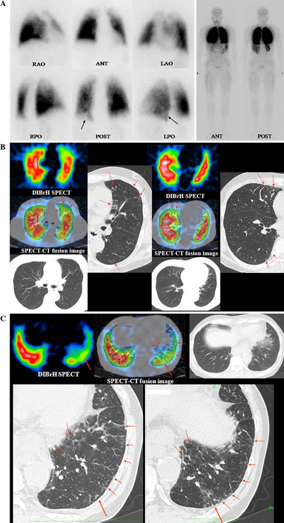 Findings of hepatopulmonary syndrome on breath-hold perfusion SPECT-CT ...