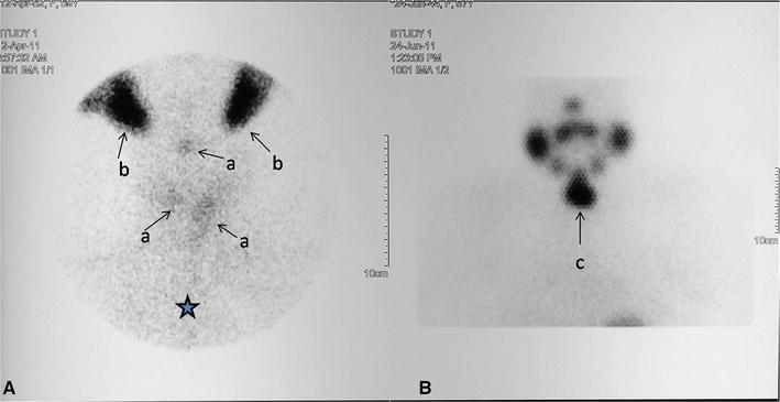 Role of Tc-99m pertechnetate for remnant scintigraphy, post ...