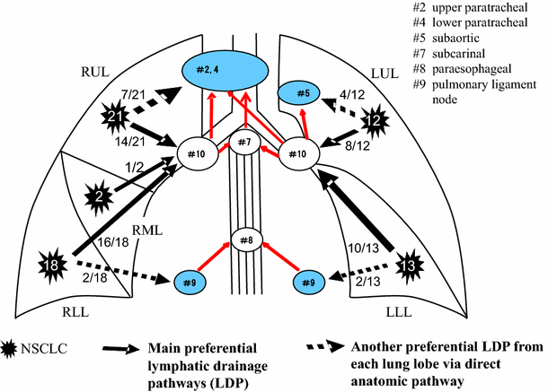 F-18-FDG-avid lymph node metastasis along preferential lymphatic ...
