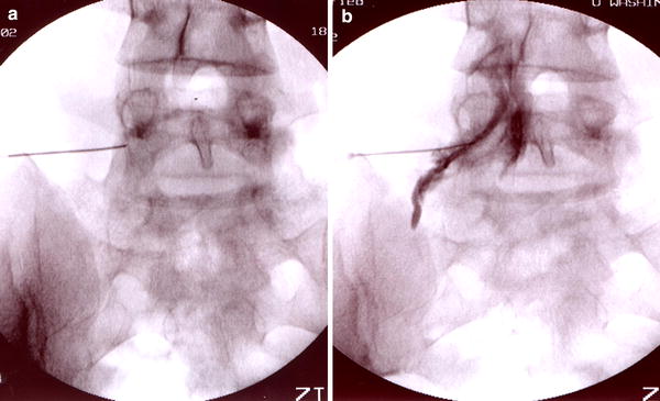 Epidural steroid injections for lumbar spinal stenosis | SpringerLink