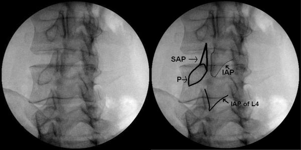 The provocative lumbar facet joint | SpringerLink