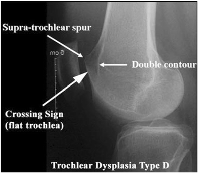 Trochleoplasty: Indications and Technique | SpringerLink