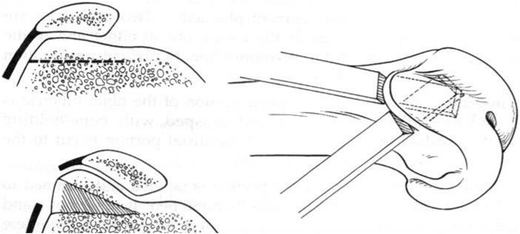 Trochleoplasty: Indications and Technique | SpringerLink
