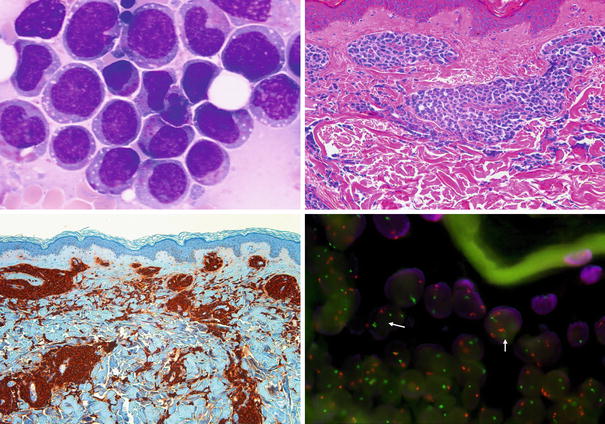 Leukemia cutis preceding systemic relapse of acute myeloid leukemia ...