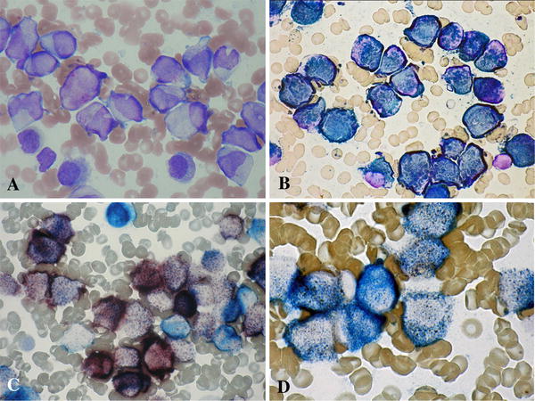 A highly positive nonspecific esterase reaction in a t(15;17)(q22;q12 ...