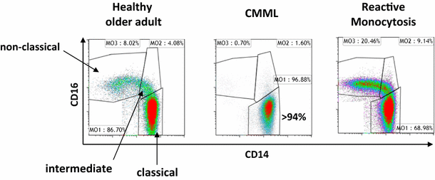 CMML: Clinical and molecular aspects | SpringerLink