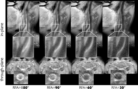 Optimization of 3D-variable refocusing flip angle RARE imaging for high ...