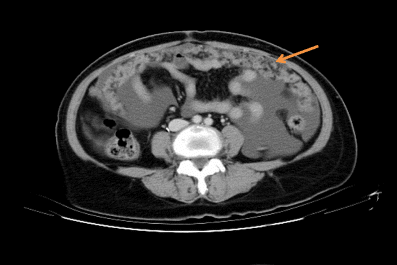 Omental cake | SpringerLink