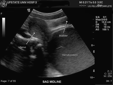 Hematocolpos secondary to imperforate hymen | SpringerLink