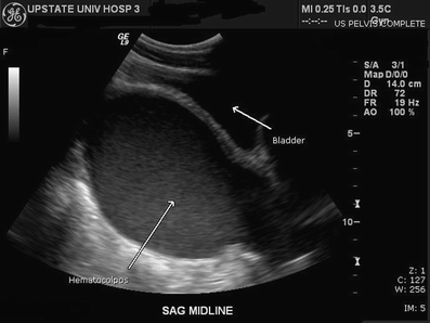 Hematocolpos secondary to imperforate hymen | SpringerLink