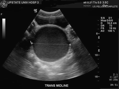 Hematocolpos secondary to imperforate hymen | SpringerLink
