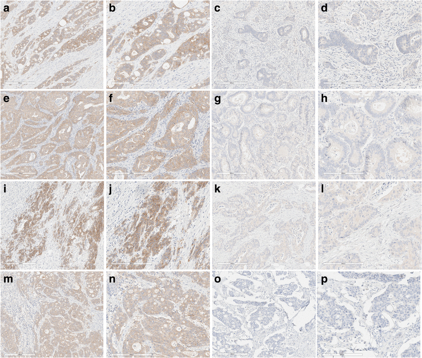 Immunohistochemistry with Anti-BRAF V600E (VE1) Mouse Monoclonal ...