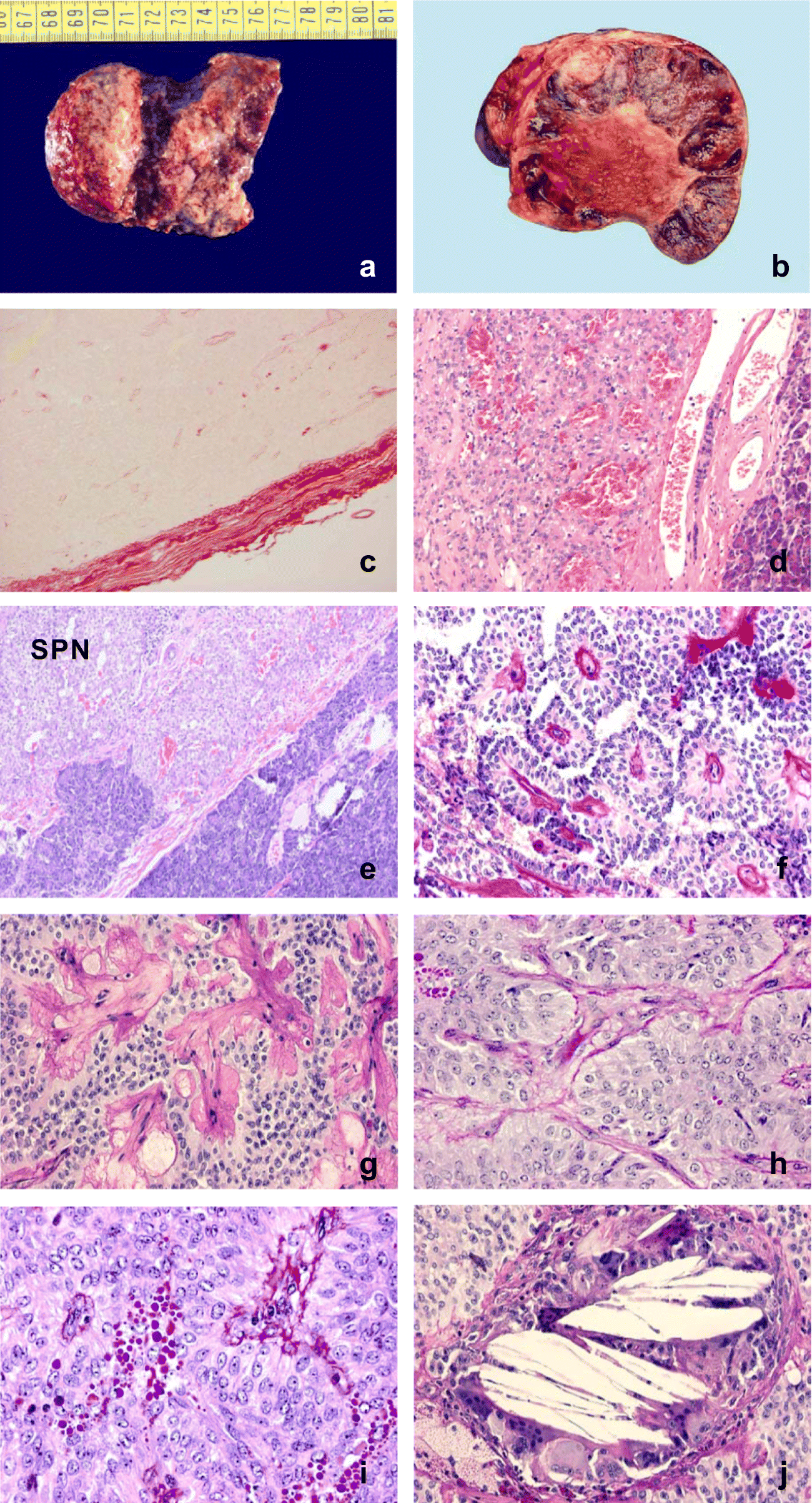 Solid-pseudopapillary Neoplasms of the Pancreas is still an Enigma: a ...