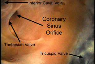 Human Coronary Venous Anatomy: Implications for Interventions ...