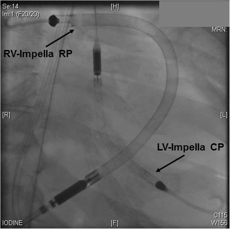 Mechanical Unloading by Fulminant Myocarditis: LV-IMPELLA, ECMELLA, BI ...