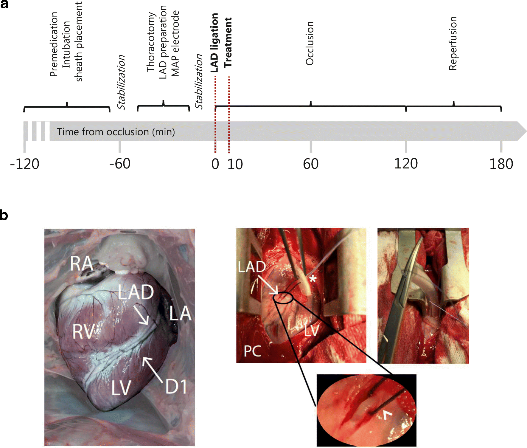 Amiodarone Treatment in the Early Phase of Acute Myocardial Infarction ...