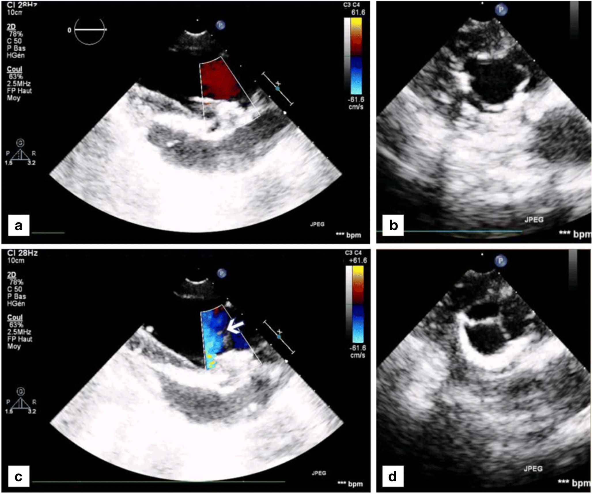 A Durable Porcine Pericardial Surgical Bioprosthetic Heart Valve: a ...