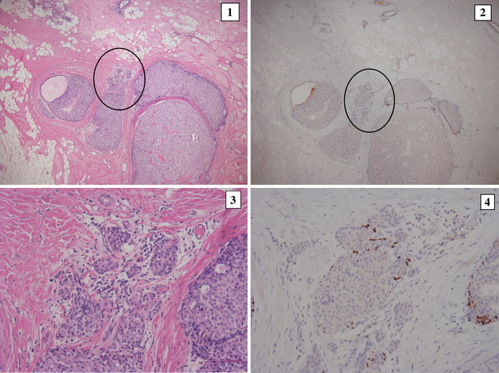 Pathological assessment of microinvasive carcinoma of the breast ...