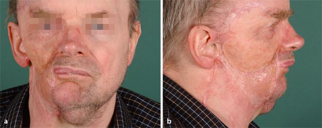 Basalioma terebrans | SpringerLink