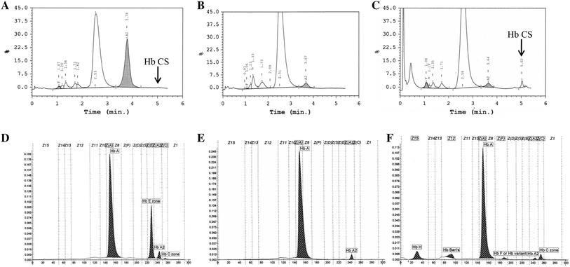 Hemoglobin Constant Spring (Hb CS) Missed by HPLC in an Hb E Trait ...